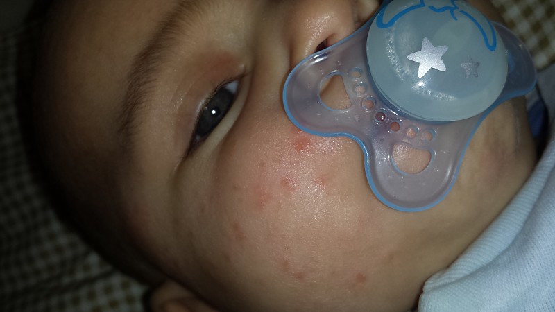 Kūdikio veiduko bėrimas | Tėvų darželis