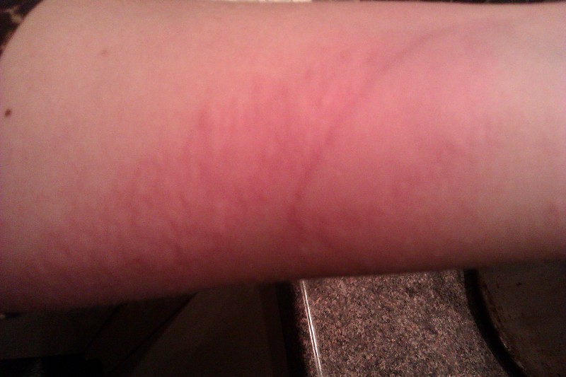 Odos bėrimas, niežėjimas, pleiskanojimas | Tėvų darželis